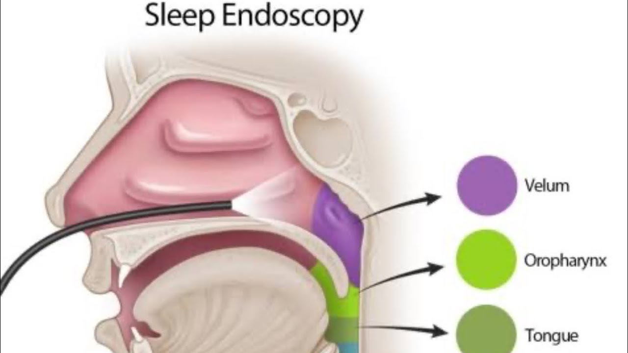 Sleep Endoscopy (DISE) for diagnosis of Snoring & Sleep Apnea - YouTube