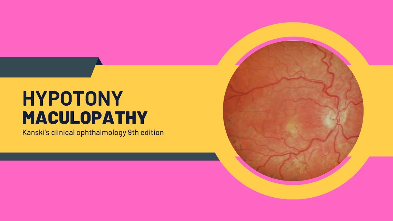 Hypotony maculopathy-Kanski's clinical ophthalmology #ophthalmology # ...