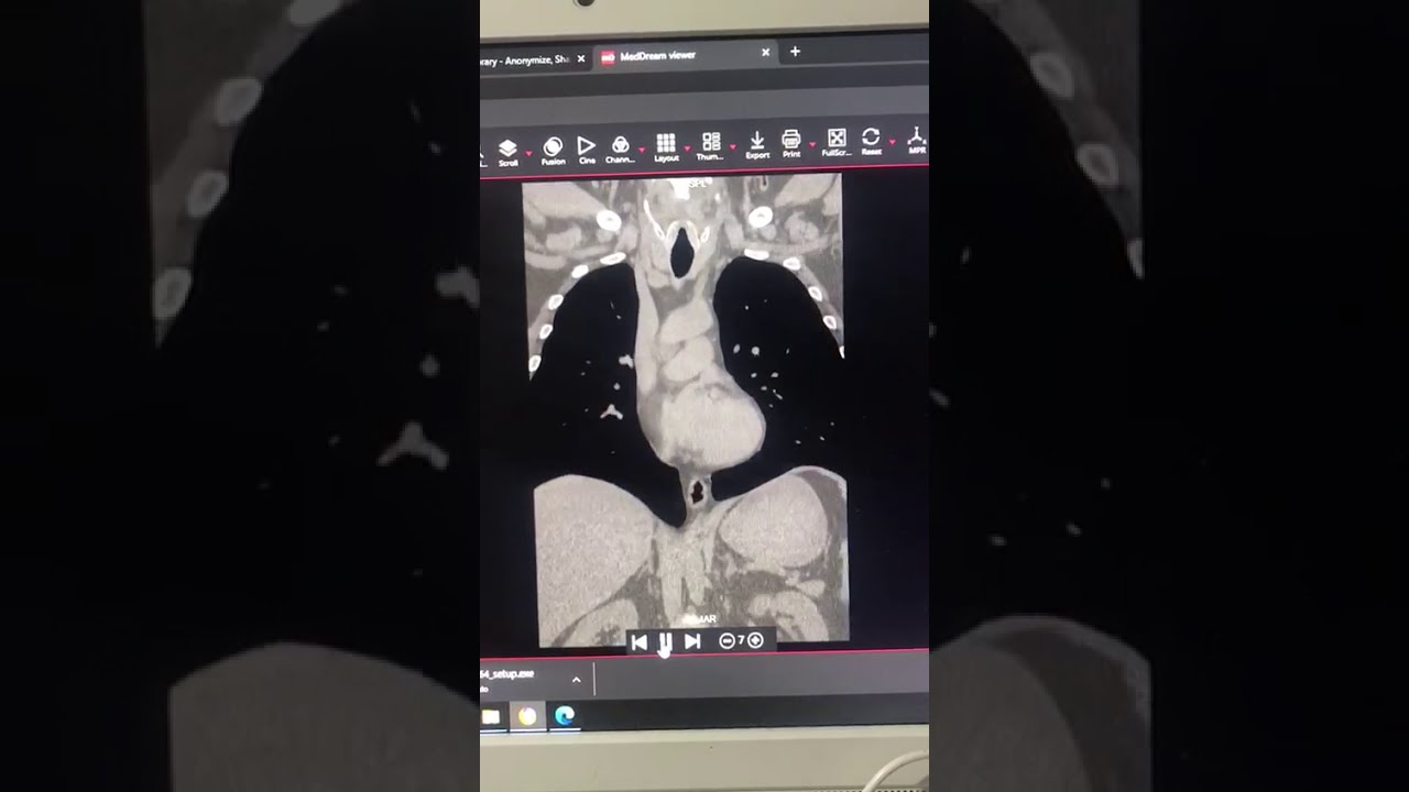 TC 03 COLUMNA DORSAL HELICOIDAL (CT) VID 20210206 WA0036 - YouTube