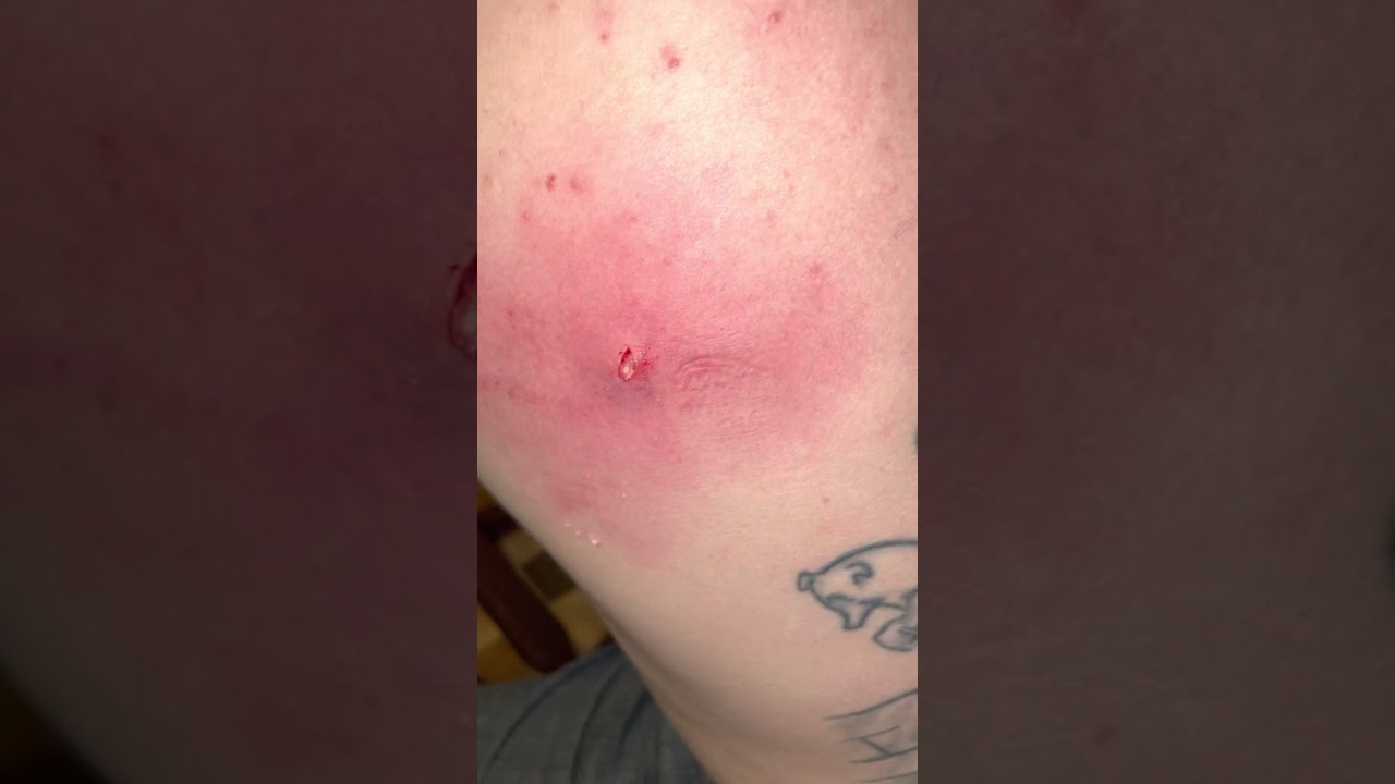 Cyst Removal DIY - YouTube