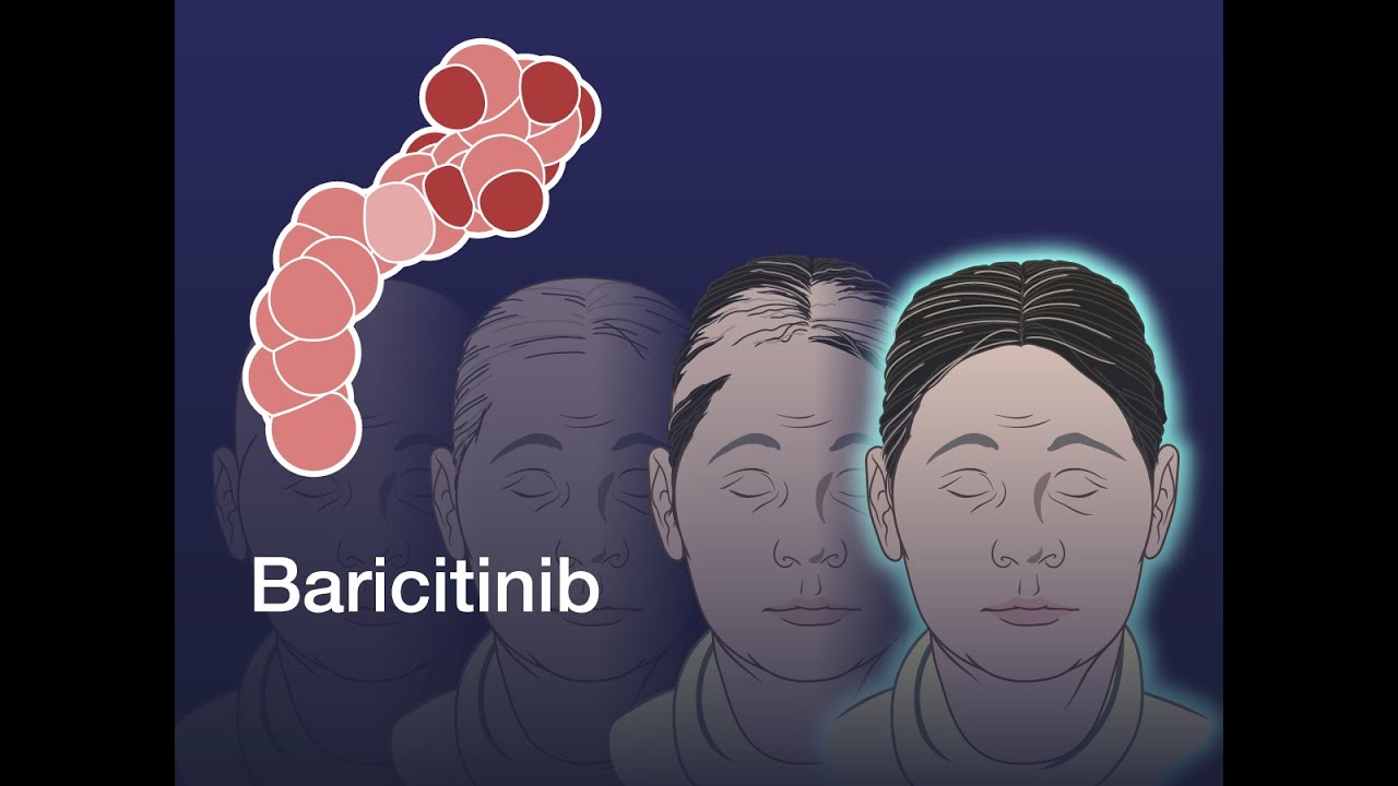 Baricitinib for Alopecia | NEJM - YouTube