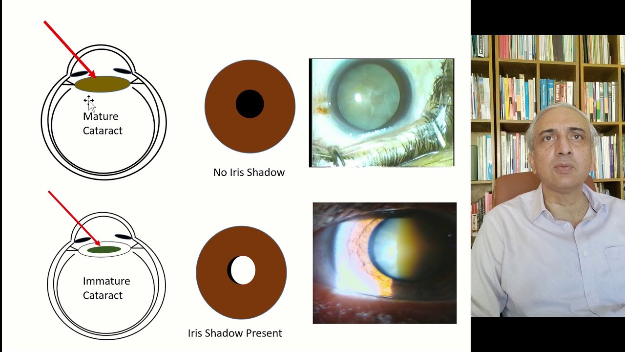 Cataract Classification Lecture - YouTube