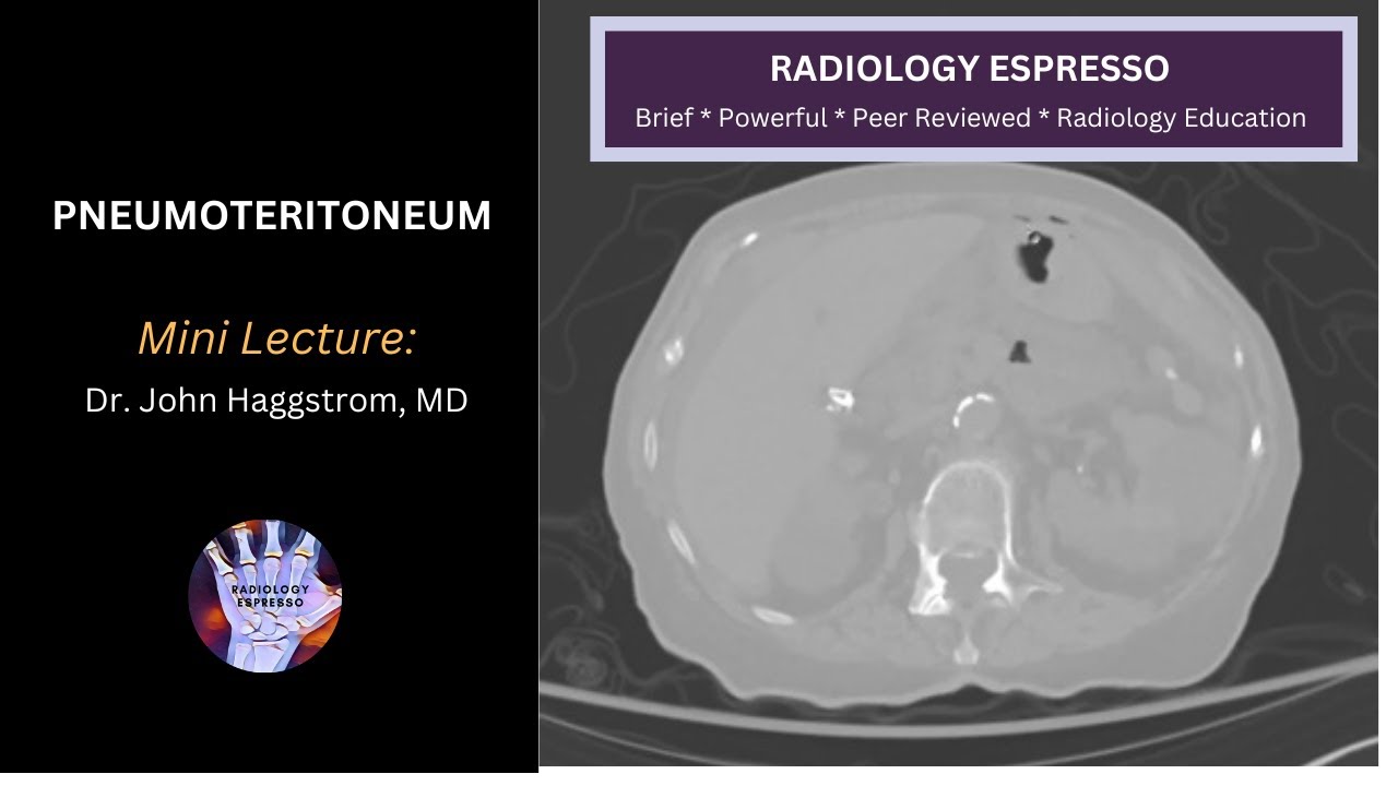 PNEUMOPERITONEUM: Mini Lecture, Dr. John Haggstrom, MD - YouTube