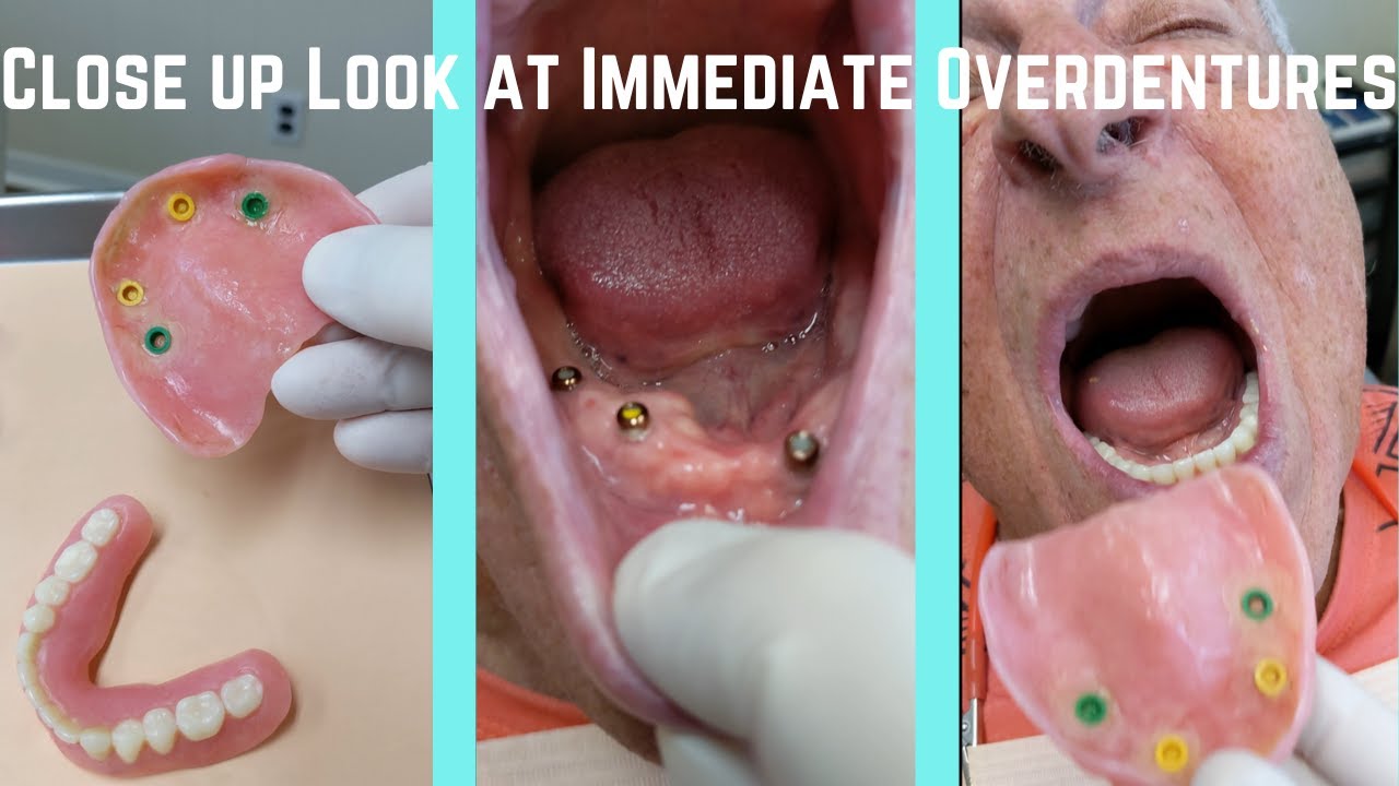 Close up look at upper and lower immediate snap-in overdentures - YouTube