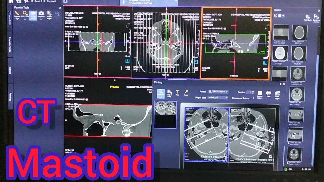 CT mastoid full prosesing, Filiming,ct mastoid,Somatom.go - YouTube