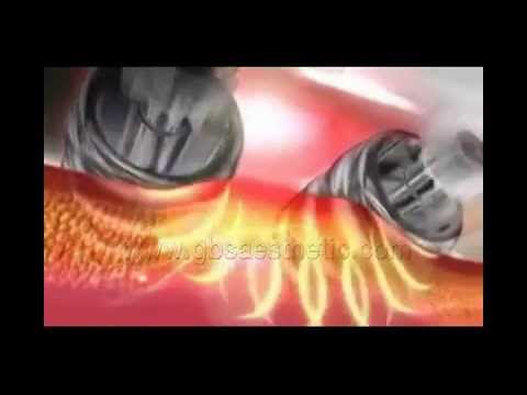 Omnishape body shaping machine-Velashape II tech+Aluma in one machine ...