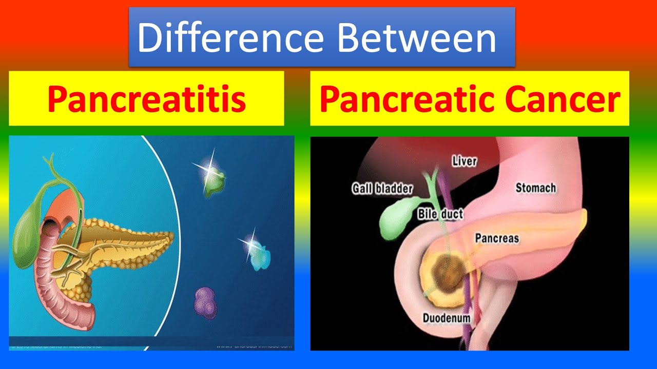 Difference Between Pancreatitis and Pancreatic Cancer - YouTube