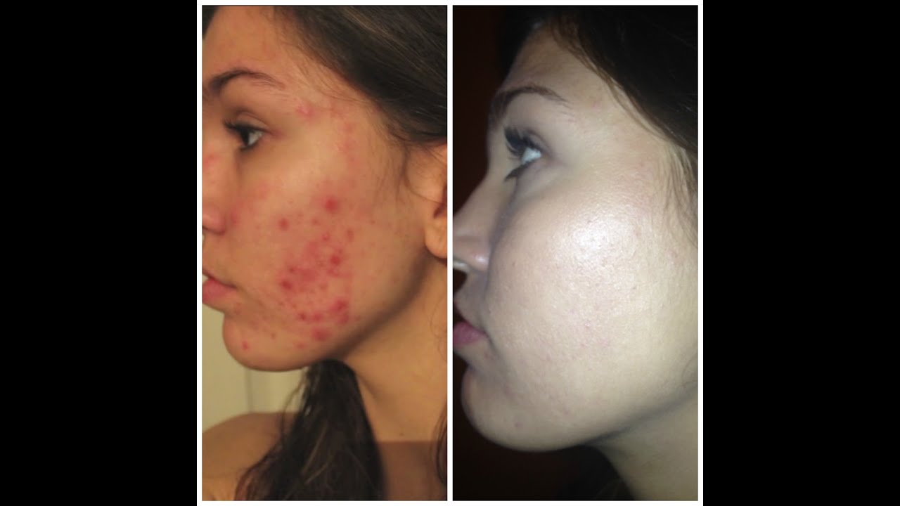 My Acne Journey Pt. 2 And How I Cured It!! - YouTube