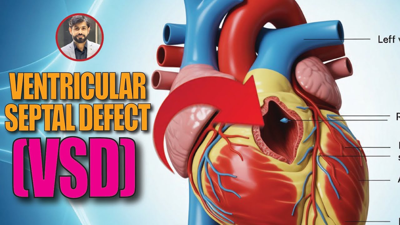 Ventricular Septal Defect VSD An Overview Prof M Amir Memon - YouTube
