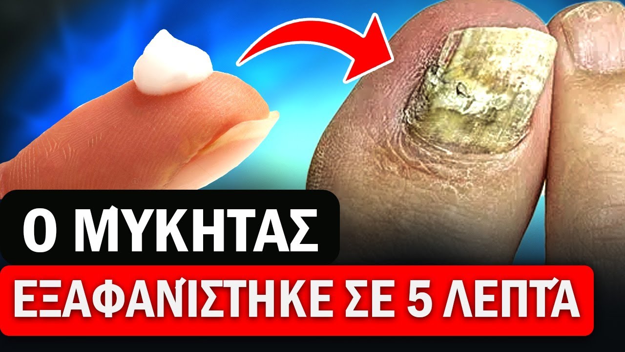 Το μυστικό των δερματολόγων: πρέπει να το απλώσεις στο νύχι... - YouTube