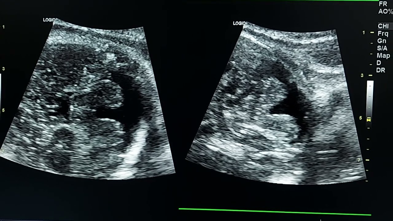 Dandy Walker Variant Fetal Ultrasound