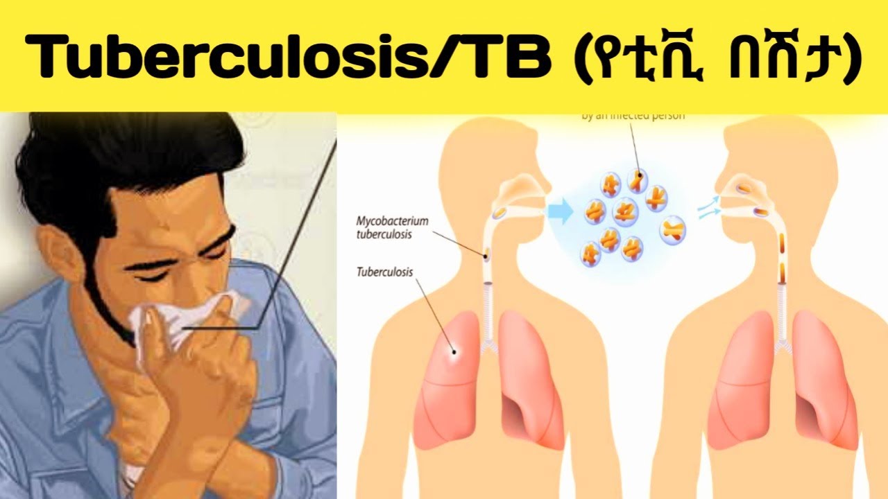 🛑Tuberculosis/#TB. (#የቲቪ በሽታ) Grade 9 Biology Lesson Unit 4. (የ9ኛ ክፍል ...