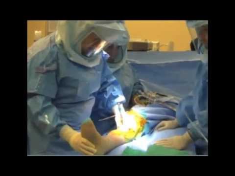 Custom MRI Minimally Invasive Knee Replacement - Part 2 of 3 - Dr. Eric ...