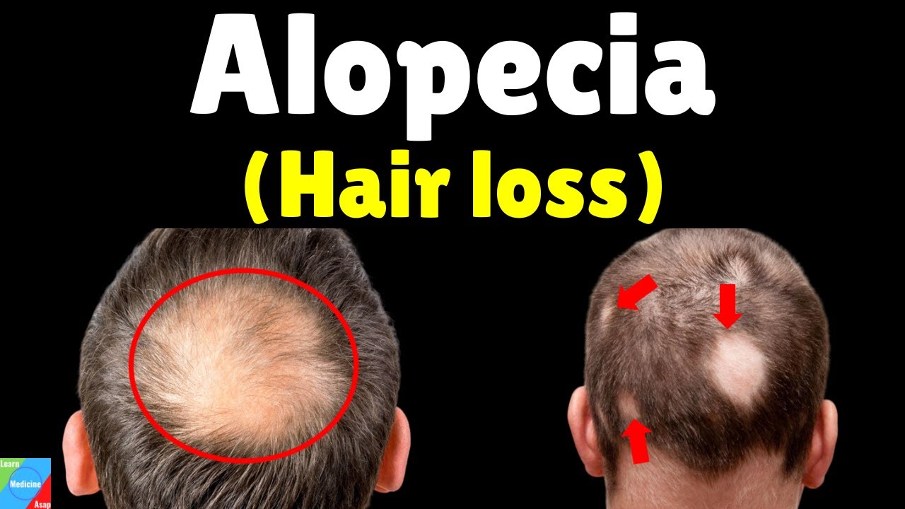 Alopecia (Hair loss) – Symptoms, Causes, Diagnosis, Treatment ...
