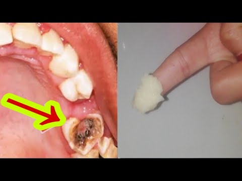 لن تلجأ لإقتلاع الأضراس المسوسة بعد اليوم ستعود كما كانت بدون تسوس ولا ثقب ولا ألم / تبييض الأسنان