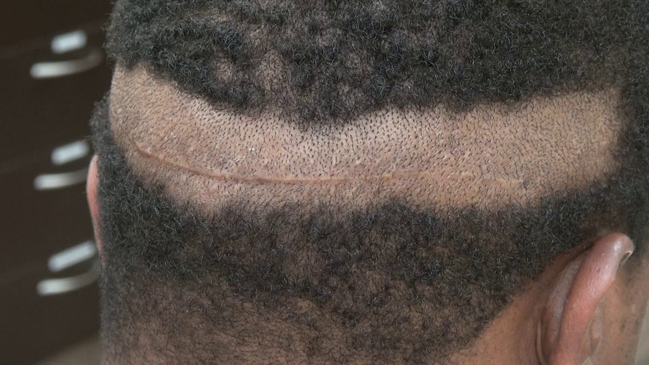 FUT Scar Hair Transplant Scar Thin Linear Line Donor Scar by Dr. Diep ...