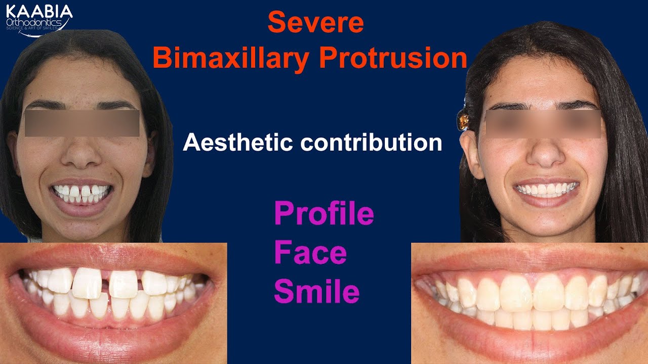Severe Bimaxillary protrusion . Aesthetic contribution : Profile , Face ...