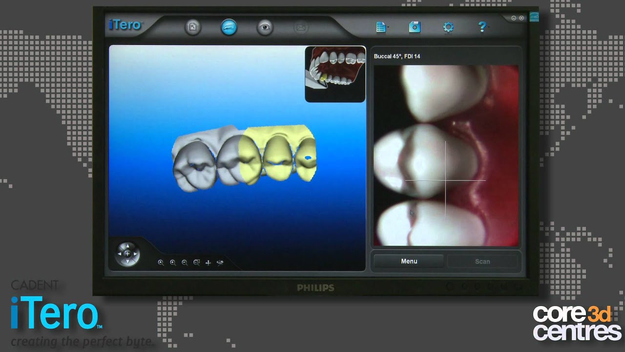 iTero Demonstration - YouTube