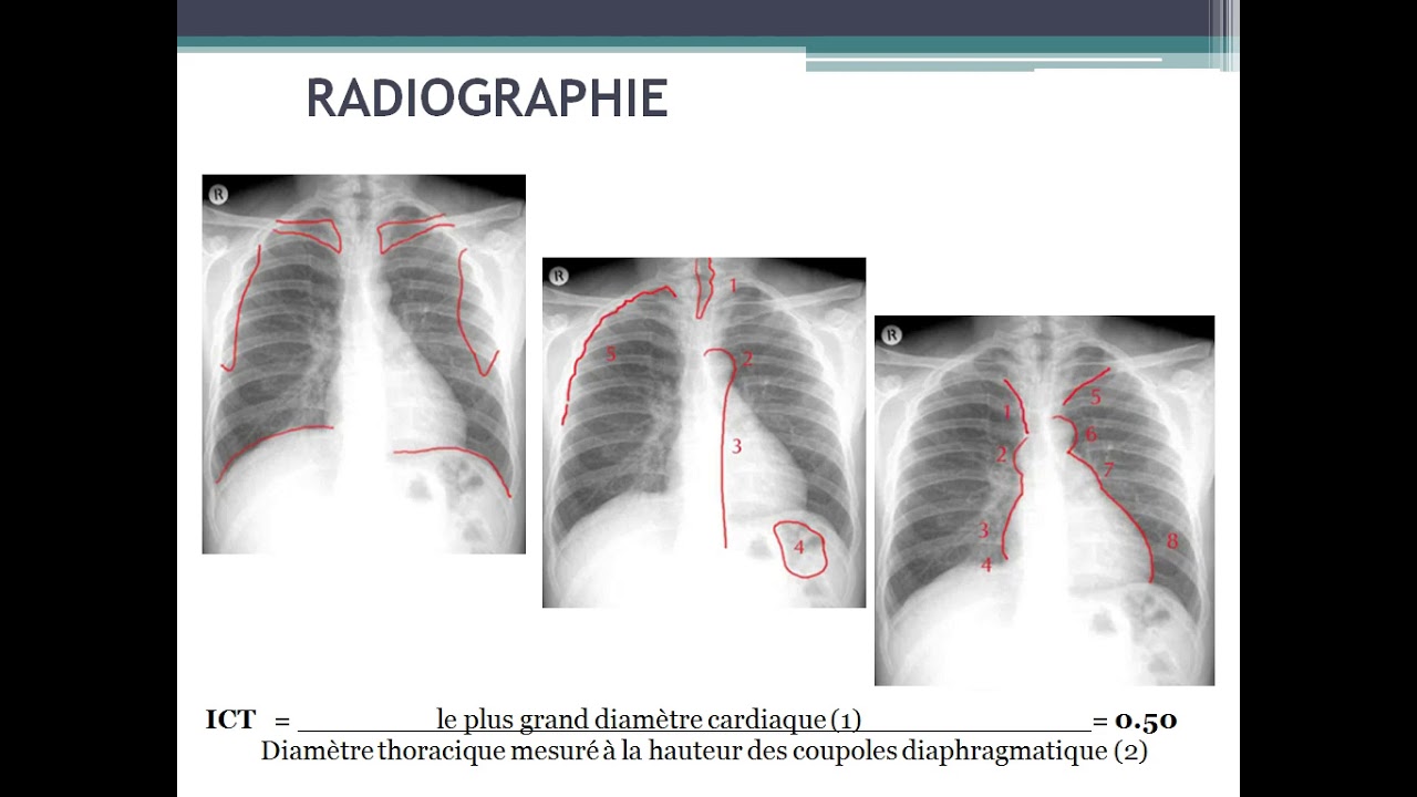 examens paracliniques en cardiologie sémiologie - YouTube