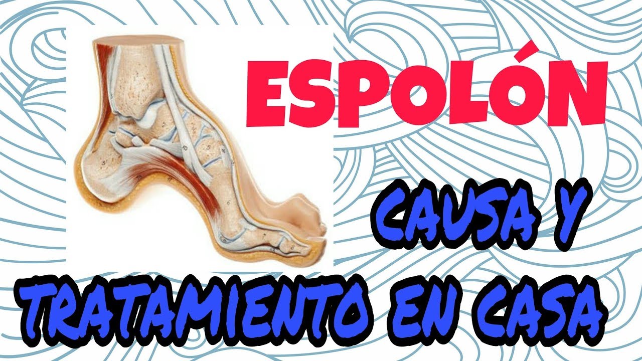 Espolon. Causas y tratamiento en casa. - YouTube