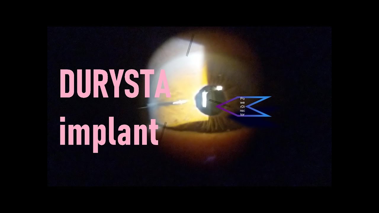 How to Durysta: Durysta Intracameral Implant for Glaucoma (MIGS) - YouTube