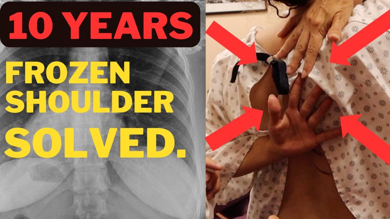 10 YEARS of Frozen Shoulder ! DRASTIC IMPROVED Movements - Drleefoot ...