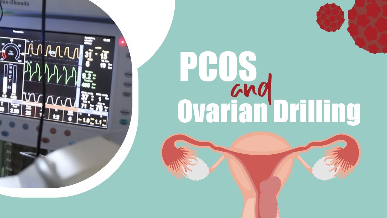PCOS and Ovarian drilling - YouTube