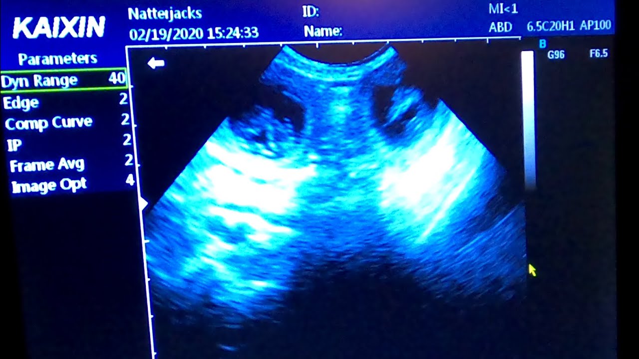 Chilli s Pregnancy Confirmation Ultrasound Scan YouTube chilli-s-pregnancy-confirmation-ultrasound-scan-youtube