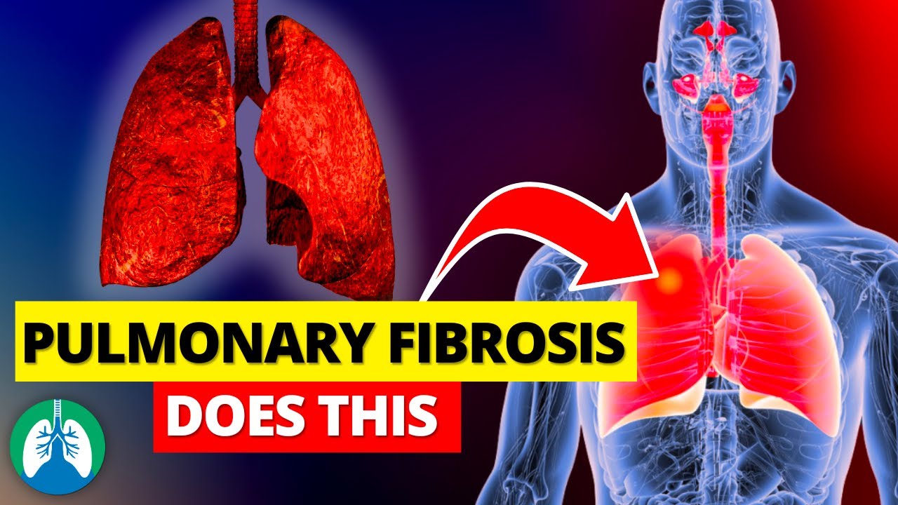 Pulmonary Fibrosis Does THIS To Your Lungs YouTube pulmonary-fibrosis-does-this-to-your-lungs-youtube