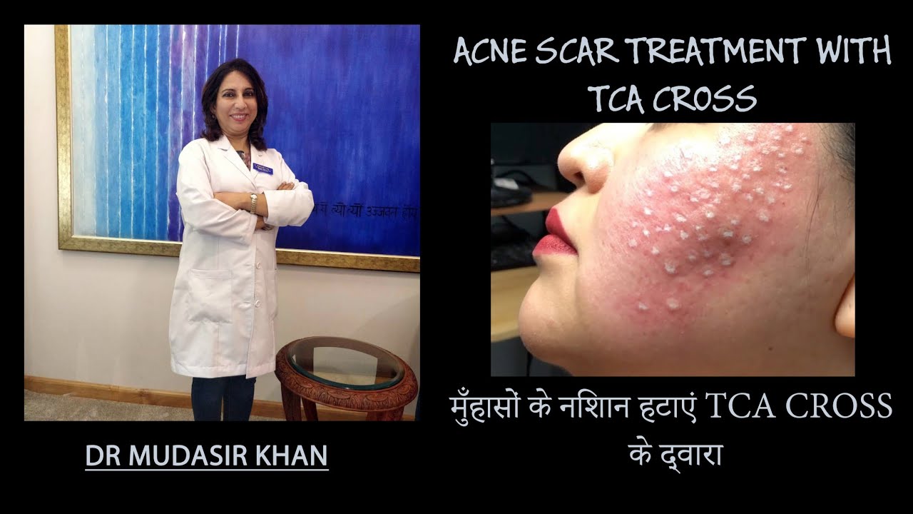 TCA CROSS FOR ACNE SCAR TREATMENT मुँहासों के निशान हटाएं TCA Cross ...