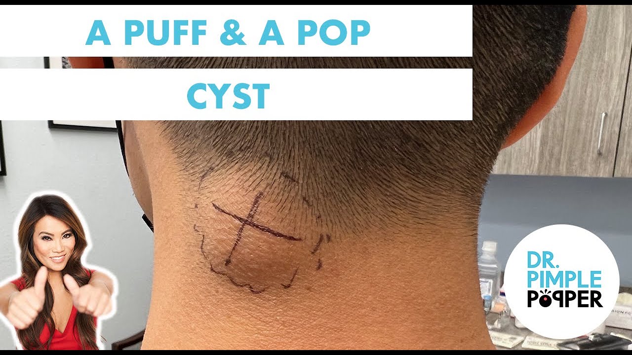 A Puff & A Pop Cyst - YouTube