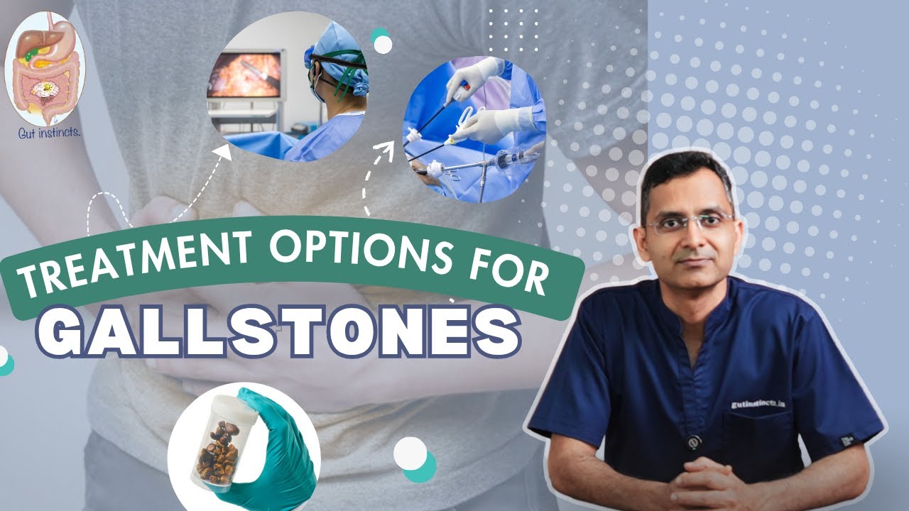 Treatment Options for Gallstones - YouTube