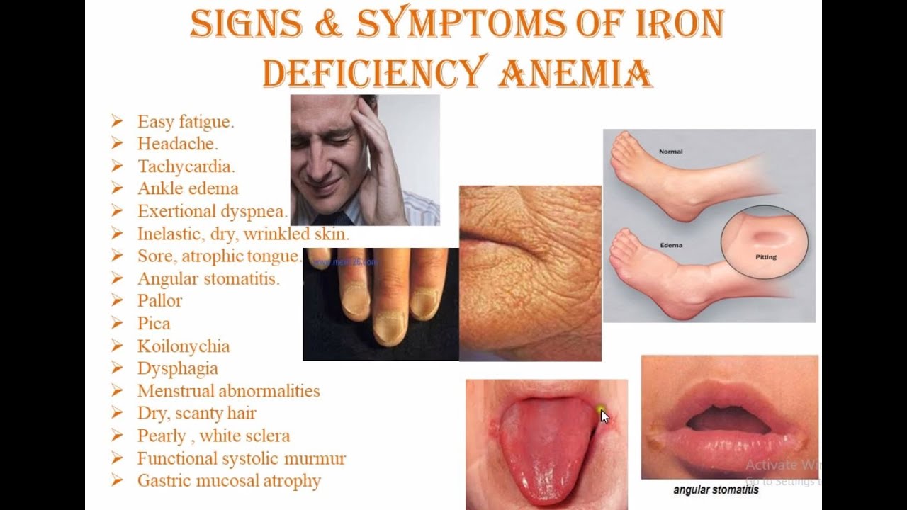 Iron Deficiency Anemia , Overview ,Causes, Signs & Symptoms, Diagnosis, Treatment #mbbs # ...