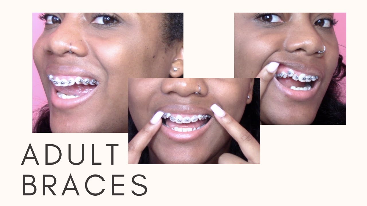 Braces Journey| Before & After (Day 1) - YouTube