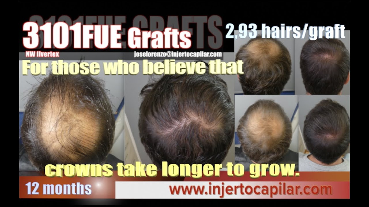 3101FUE Grafts.NW IIvertex.Crown restoration. 2,93 h/graft. 10 months ...