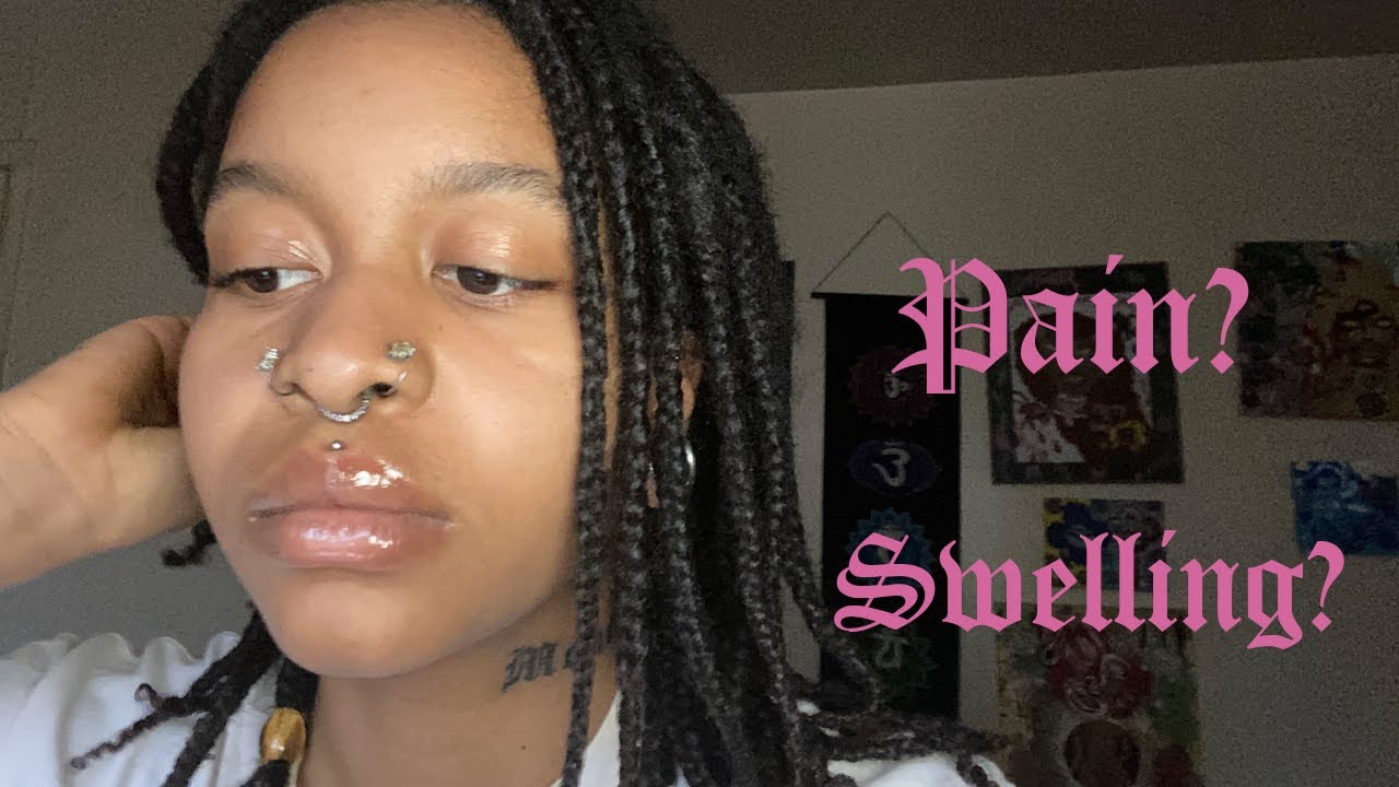 Philtrum healing update | week 2 - YouTube