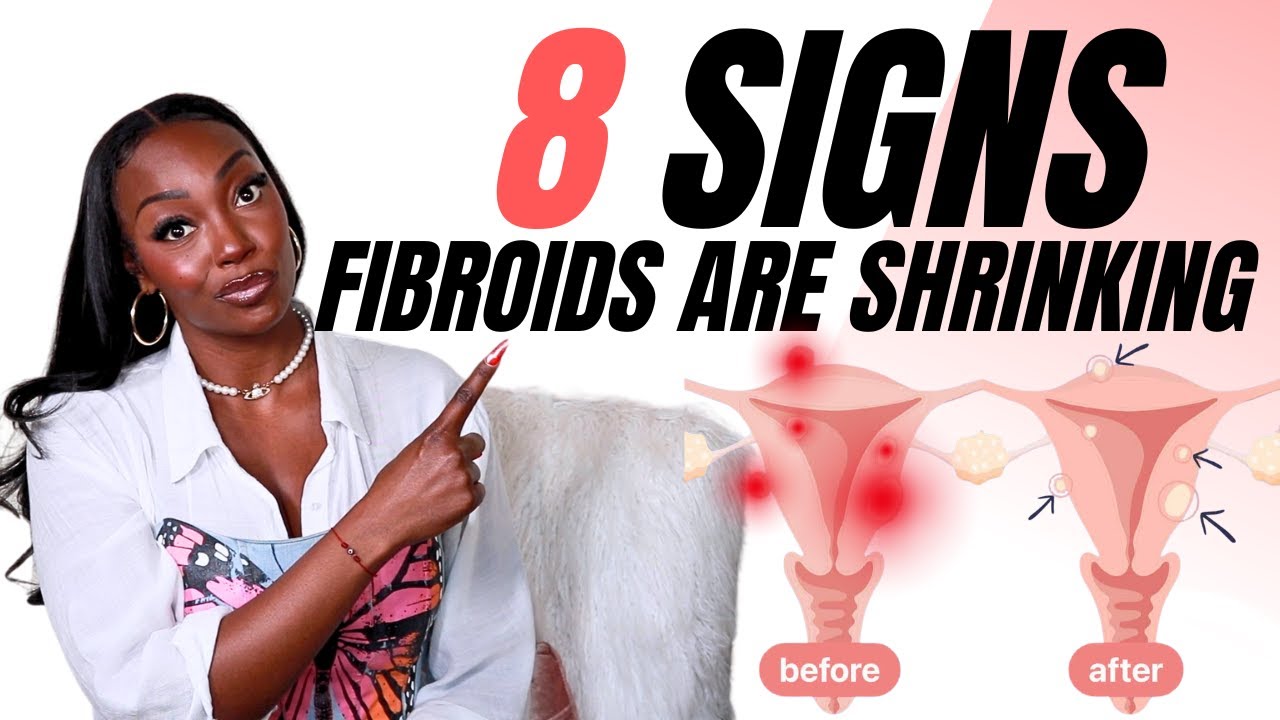 8 Signs Your Fibroids Are SHRINKING (Naturally!) - YouTube