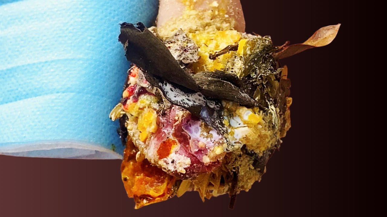 RELAX! Super curly toenails Onychomycosis Is Very Hard, Perfect ...
