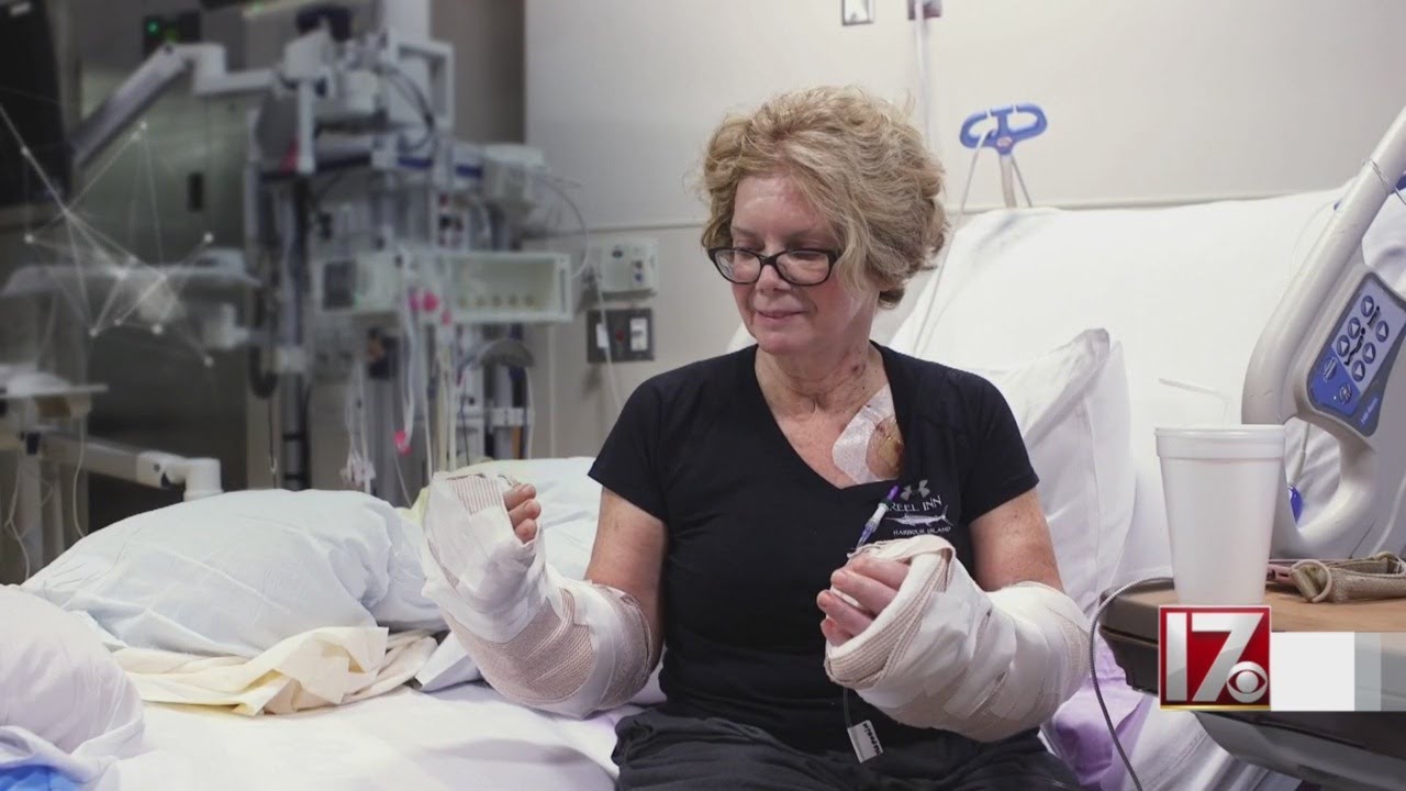 Woman who lost her hands, feet gets life-changing procedure from Duke ...