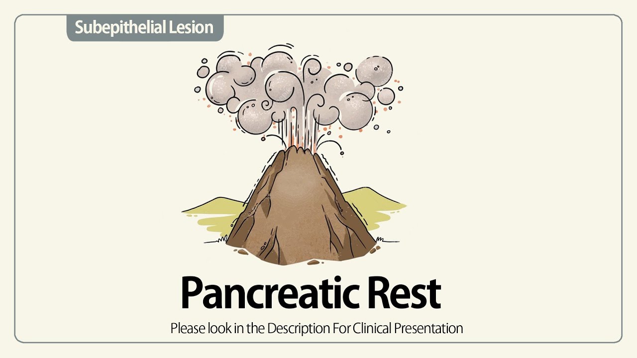 Pancreatic Rest (heterotopic pancreatic tissue) - YouTube