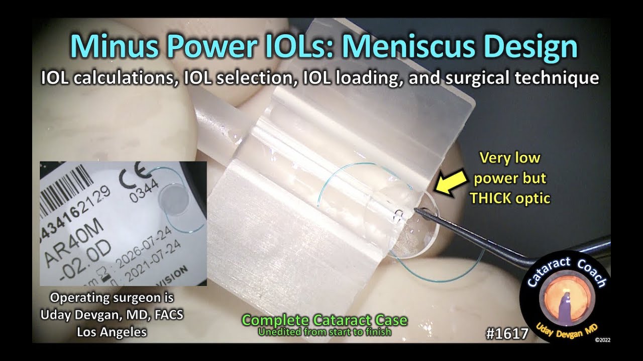 CataractCoach 1617: minus power IOLs: meniscus design including IOL ...