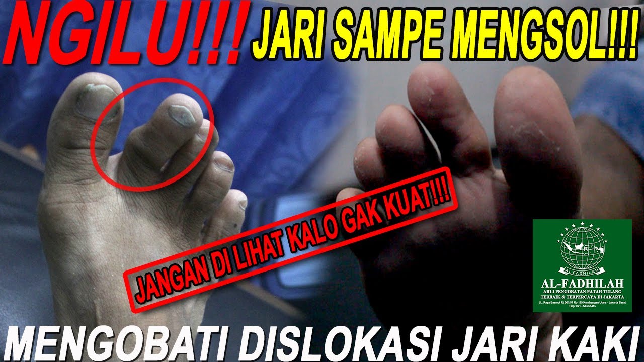 SEKEJAP!!! MENGOBATI DISLOKASI JARI KAKI!!! | Pengobatan Al-Fadhilah ...