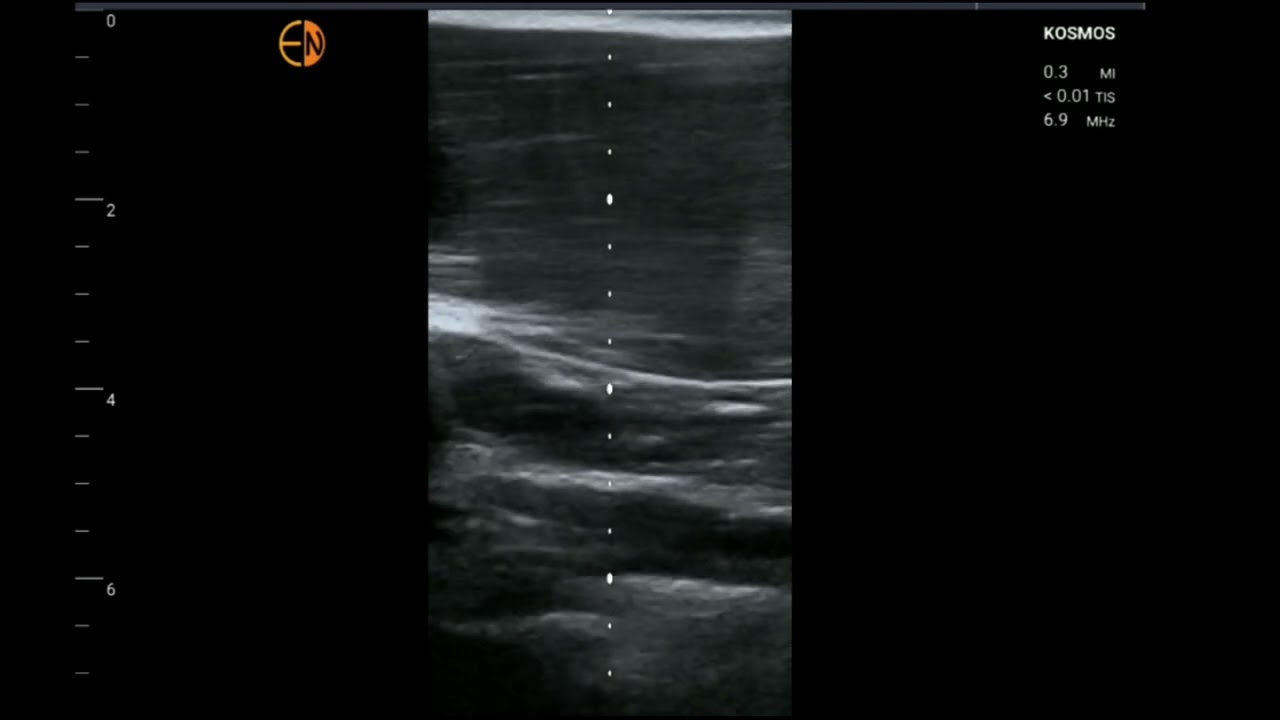 Chest Ultrasound: Pectoralis Major Normal - YouTube