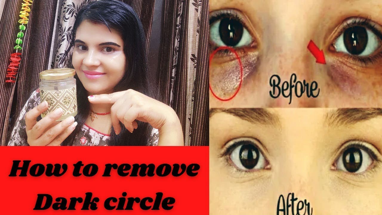 Dark circle cream!Home remedies removing dark circle! How to get rid of ...