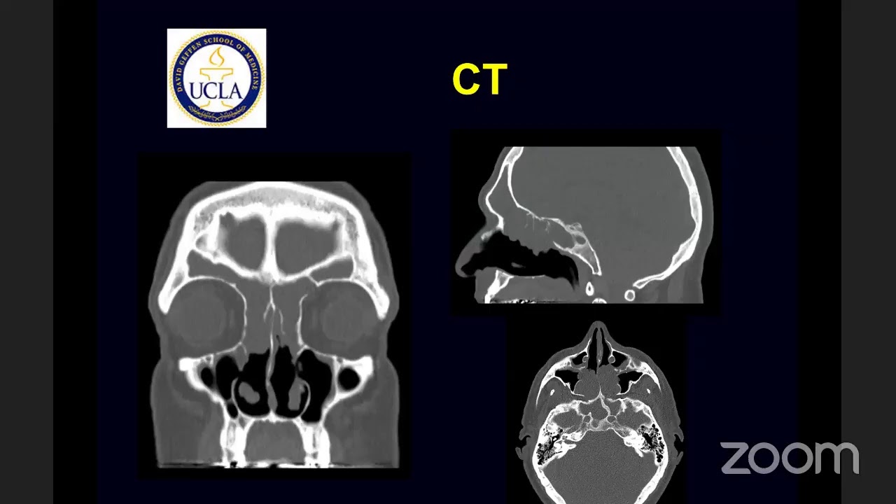 Novel surgical procedures for recalcitrant chronic sinusitis - YouTube