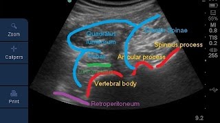 Quadratus Lumborum Ql3 Block Usg Guided Youtube The Efficacy Of