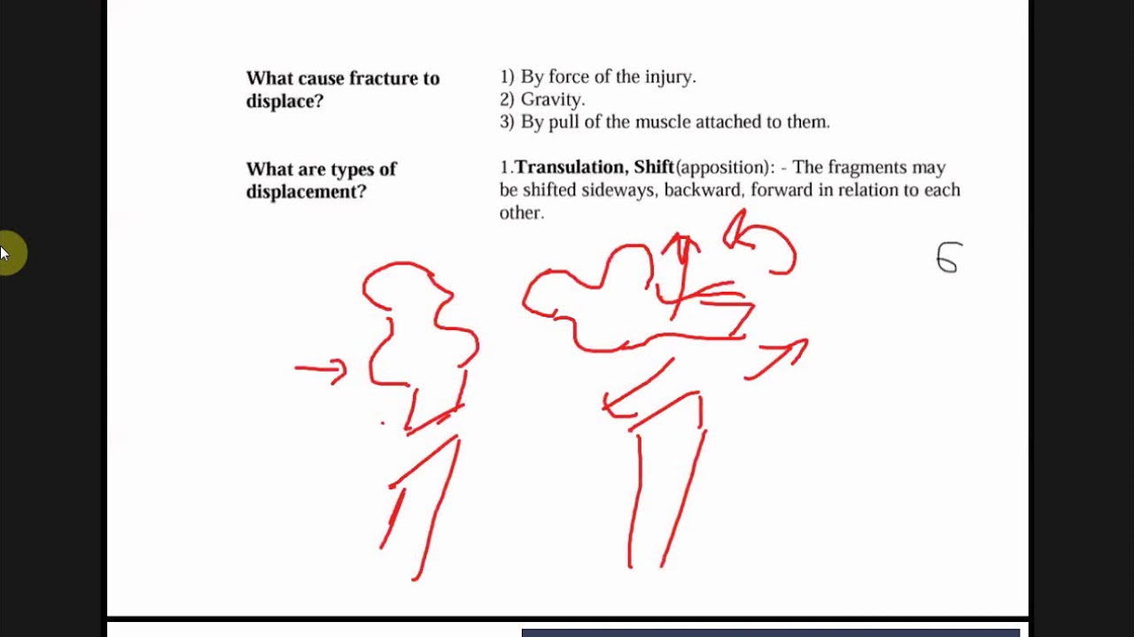 Principles of fractures - YouTube