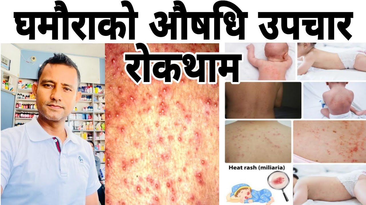 Miliaria infection treatment |के तपाईँलाई घमौरा आएको छ? यसको उपचार तथा ...