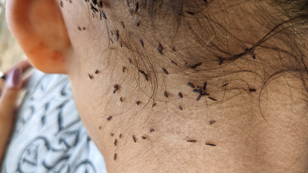 How to pick out thousand head lice from head - Head lice removal by ...