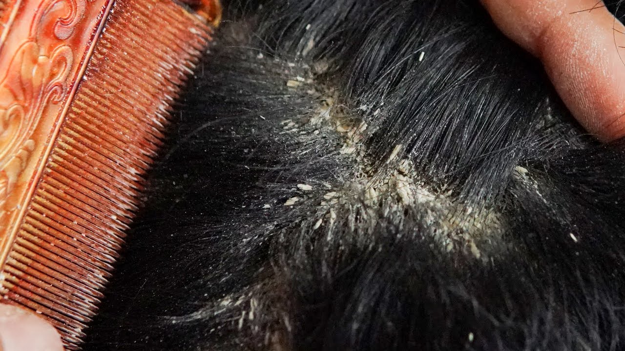 Scratching Back Side Dandruff!! Huge Flakes - YouTube